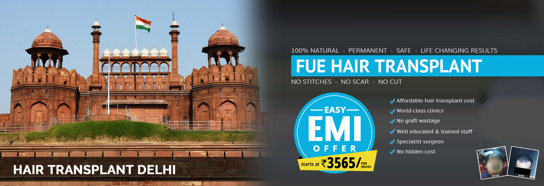 Hair Transplant In Delhi Fue And Fut Hair Transplant In Delhi